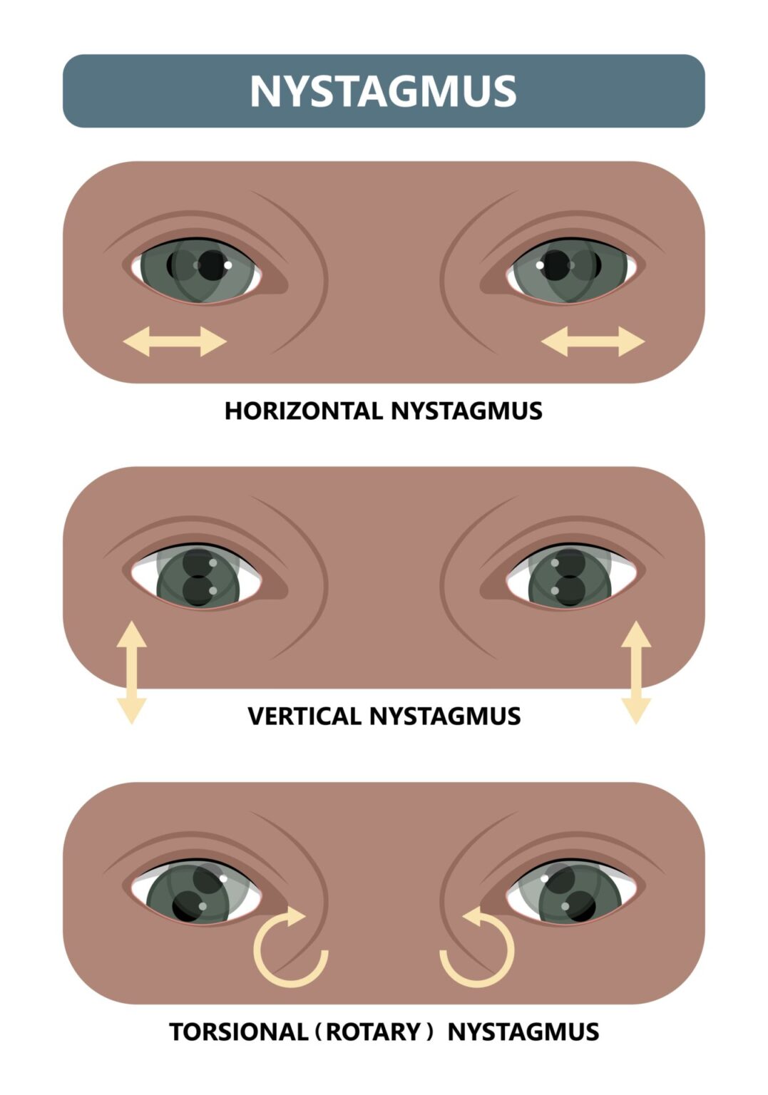 What Is Nystagmus? A Deep Dive Into This “Dancing Eye” Condition