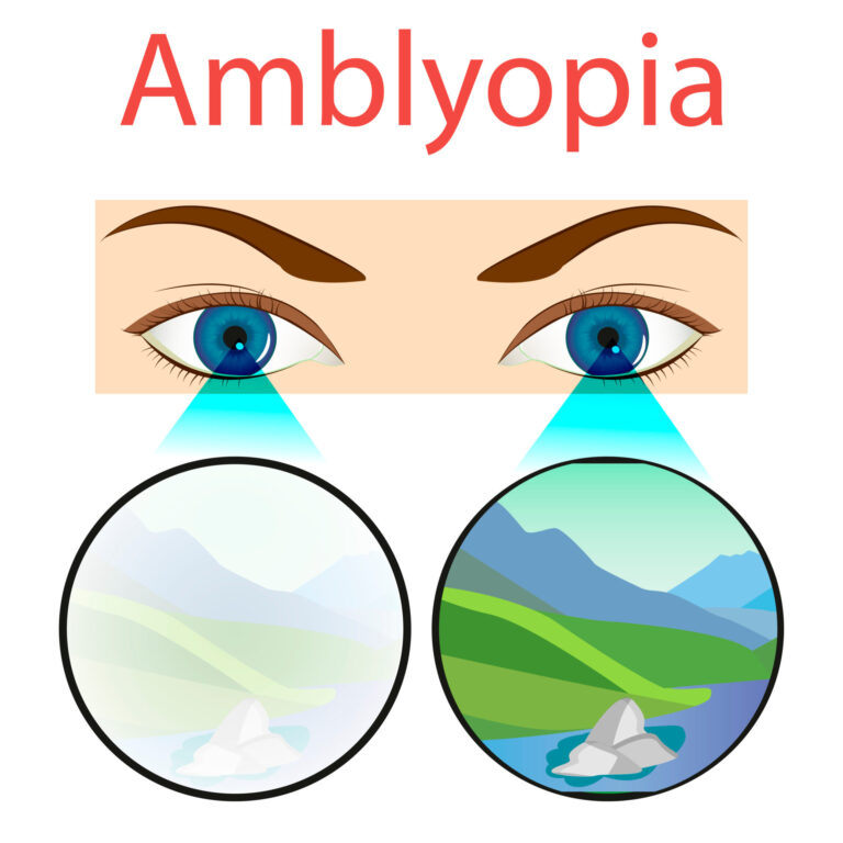 Amblyopia vs. Strabismus: Two Common Childhood Eye Conditions