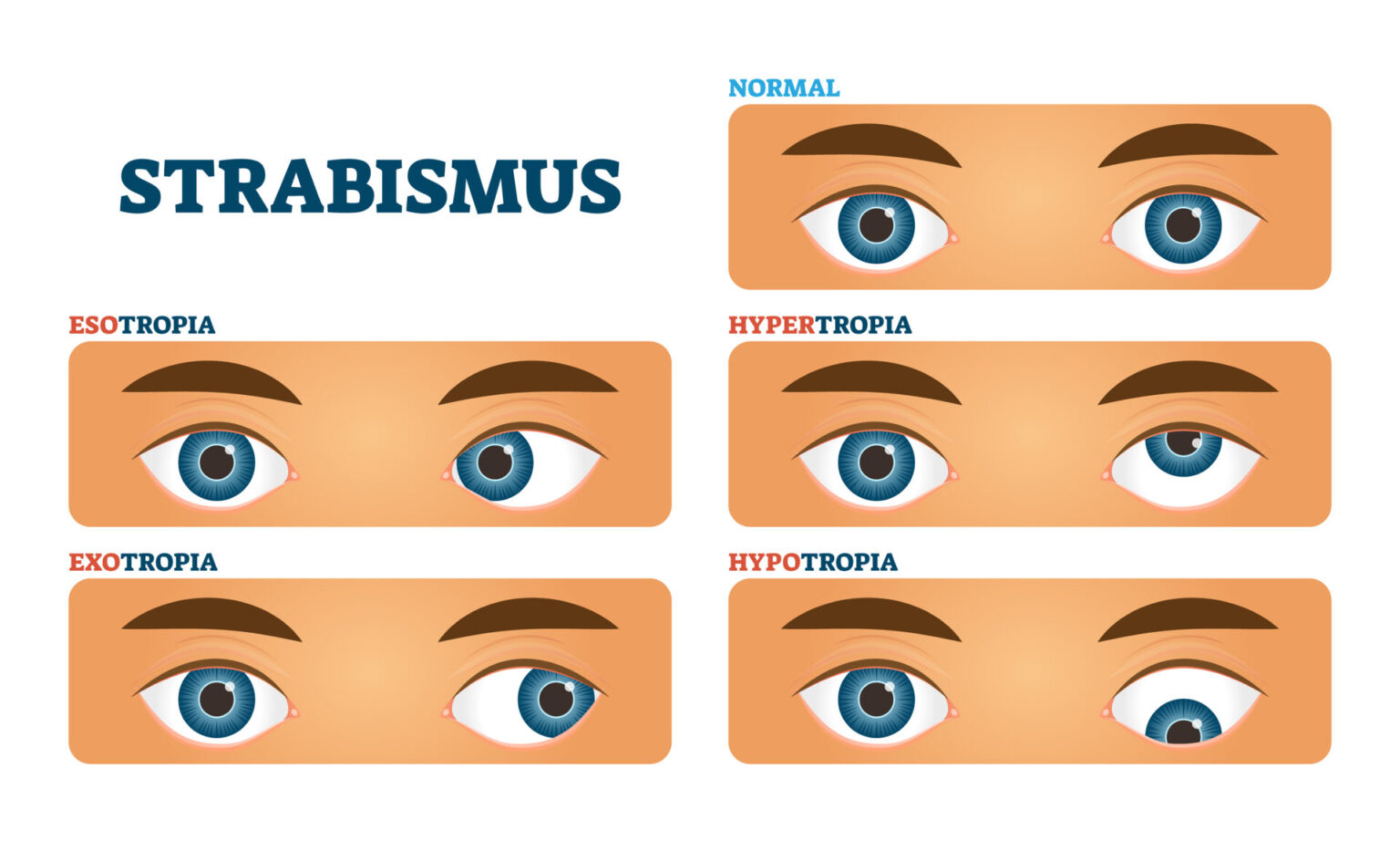 Amblyopia vs. Strabismus: Two Common Childhood Eye Conditions