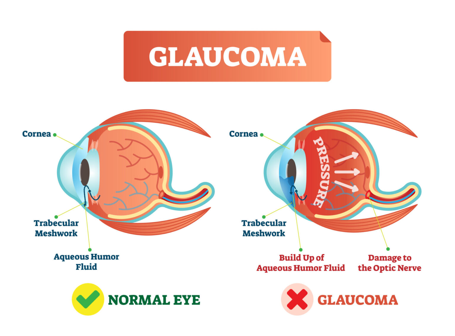 The 4 Types of Glaucoma, Explained